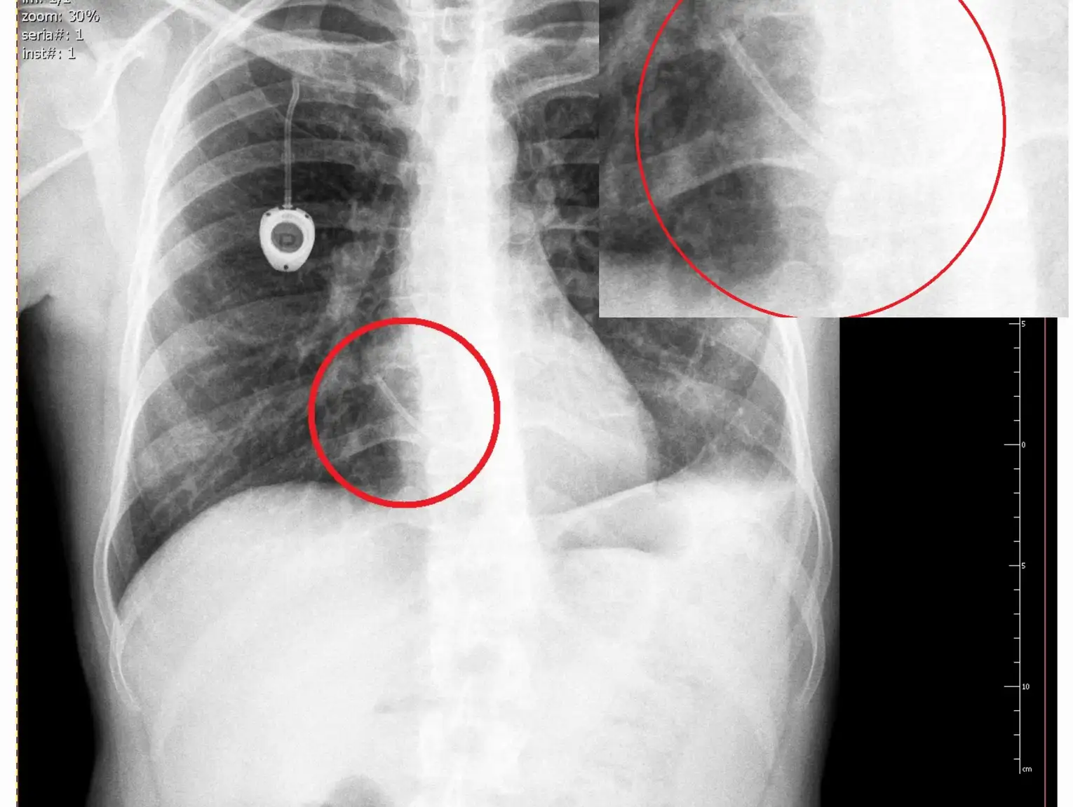 Dren mierzący 8 cm trafił do komory serca. Mieszkanka Brześcia walczy z ...